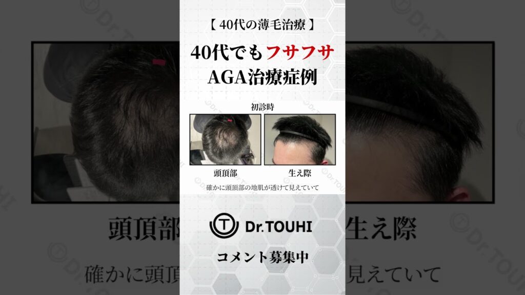 【薄毛治療】40代でもフサフサに！AGA治療症例のリアルをご紹介！ | 40代、男のアンチエイジング生活ブログ